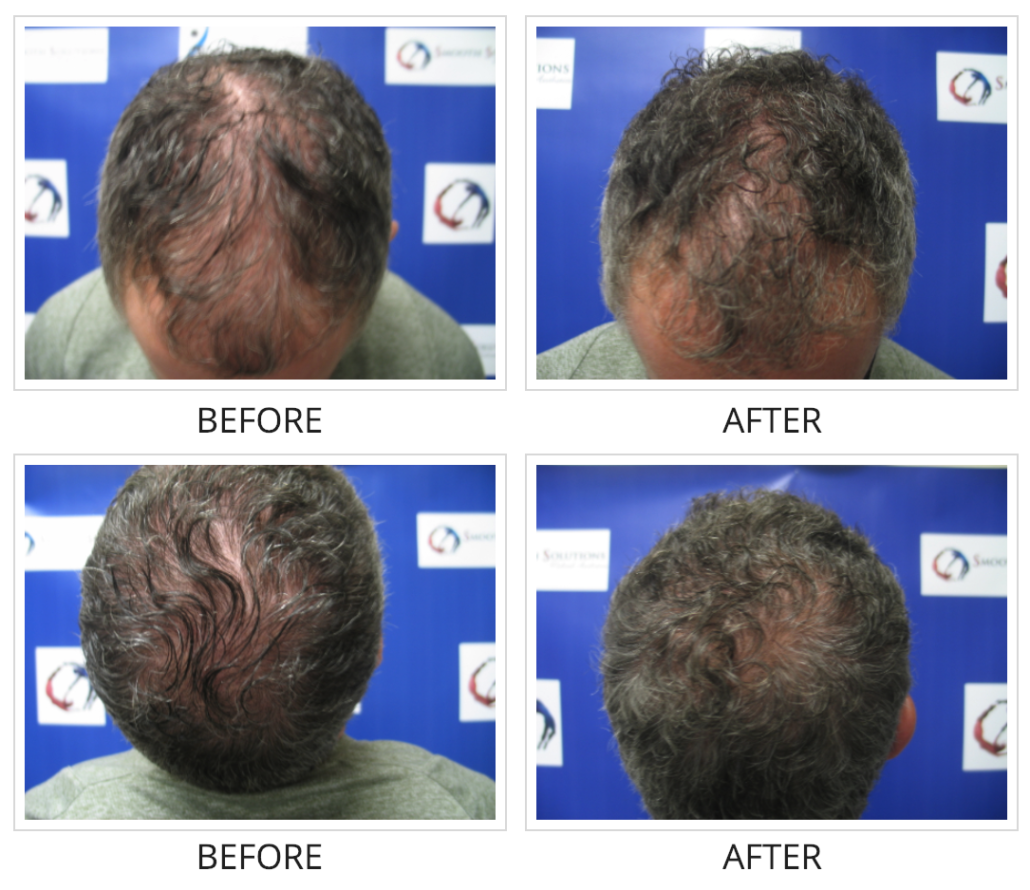 Hair Restoration Without a Transplant | Dr. Jack Bertolino